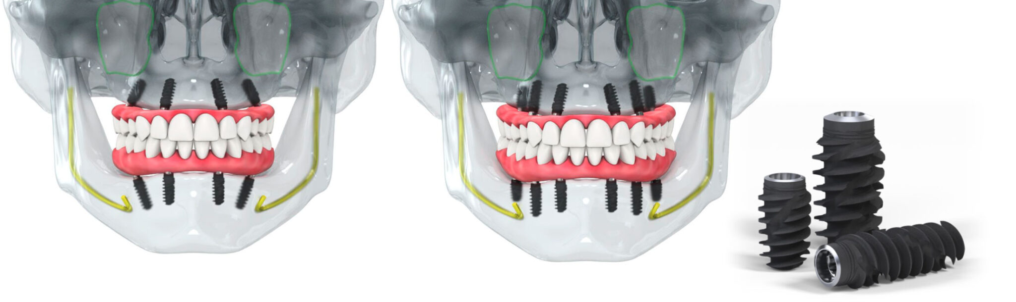Hybrid Teeth | Oral & Maxillofacial Surgery Associates